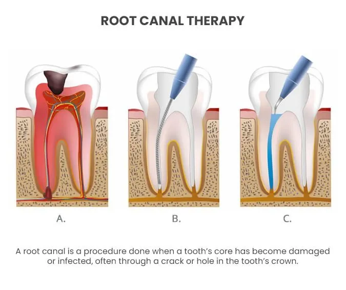 How Much Does Retreatment of Root Canal Cost and Why?