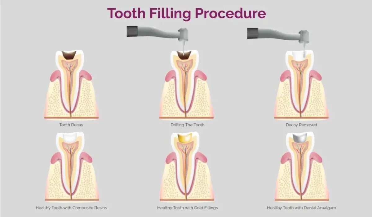 Tooth Filling vs Root Canal – Know Before You Choose